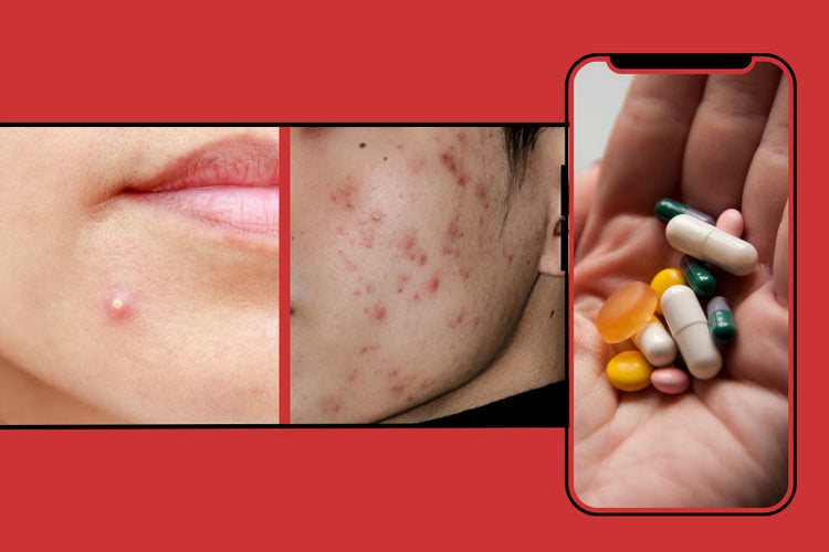 This popular acne treatment may cause serious lower back pain | Zanskar ...